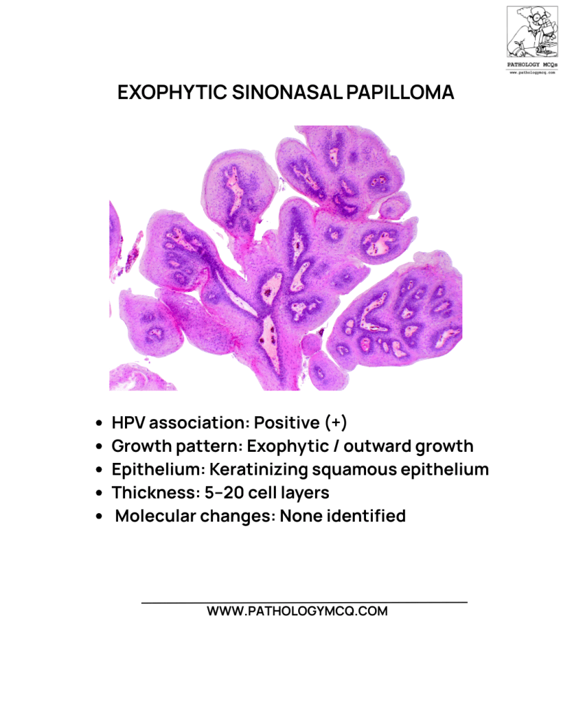 Sinonasal Papilloma Histopathology: Types, HPV Association & Diagnostic ...