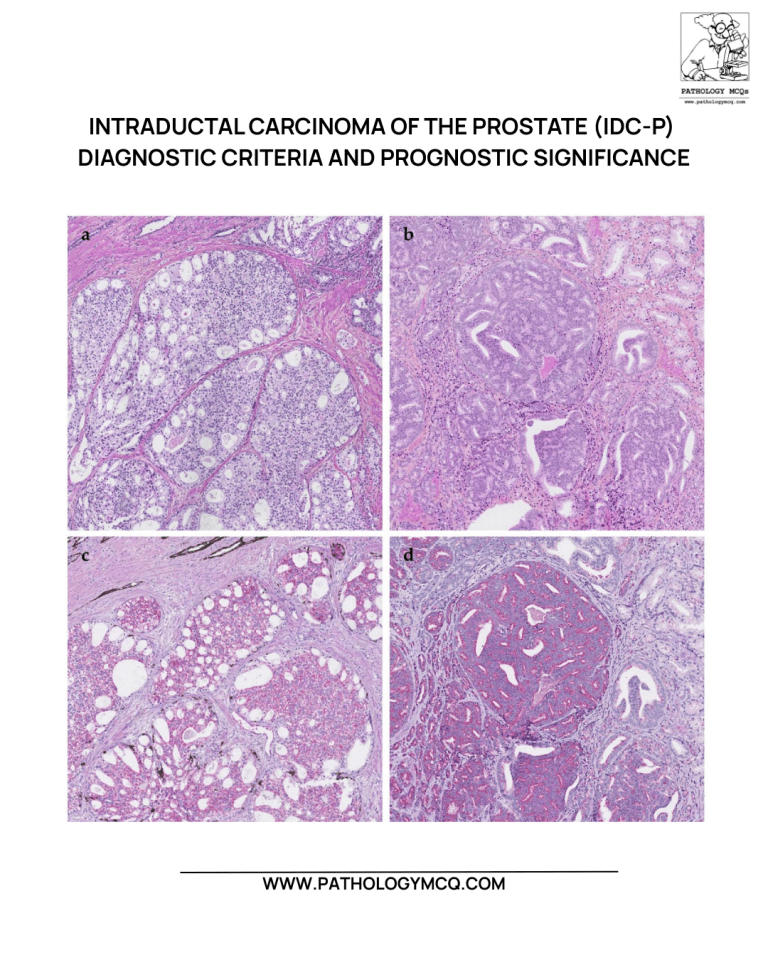 Intraductal Carcinoma of the Prostate (IDC‑P): Histology, Diagnostic ...