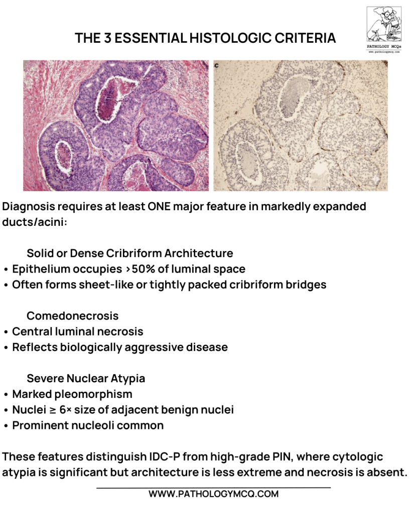 Intraductal Carcinoma of the Prostate (IDC‑P): Histology, Diagnostic ...