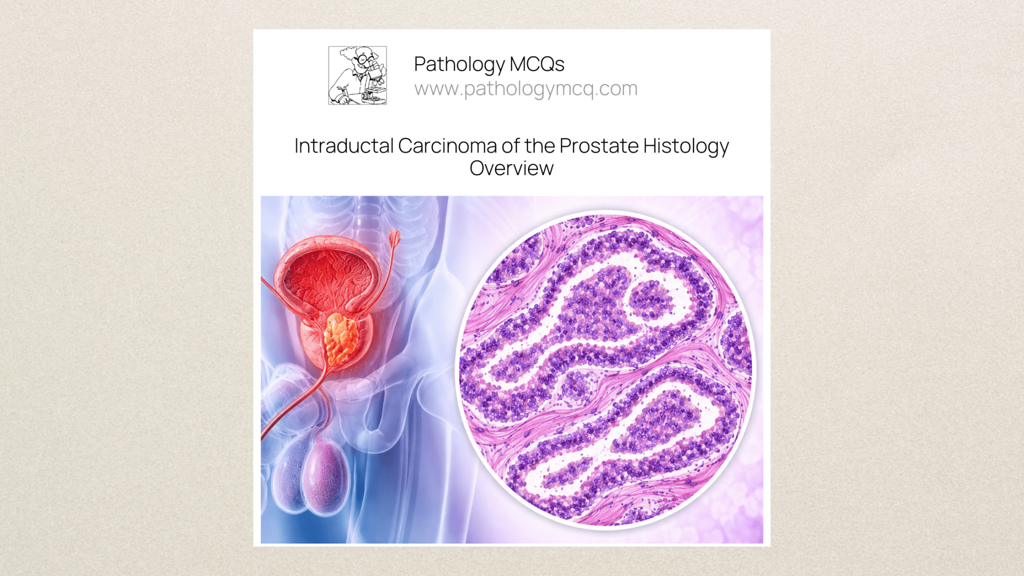 Intraductal Carcinoma of the Prostate (IDC‑P): Histology, Diagnostic ...