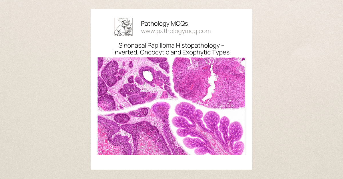 Sinonasal Papilloma Histopathology: Types, HPV Association & Diagnostic ...
